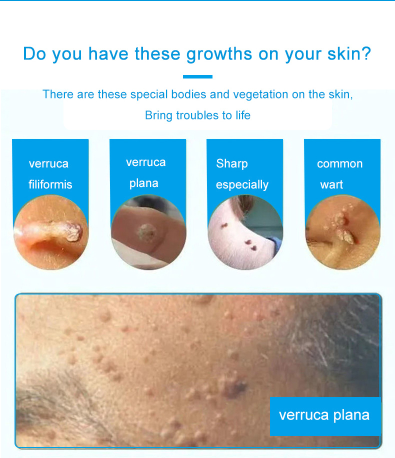 Wart Remover Common Warts Flat Warts Wart Removal Solution - Temu