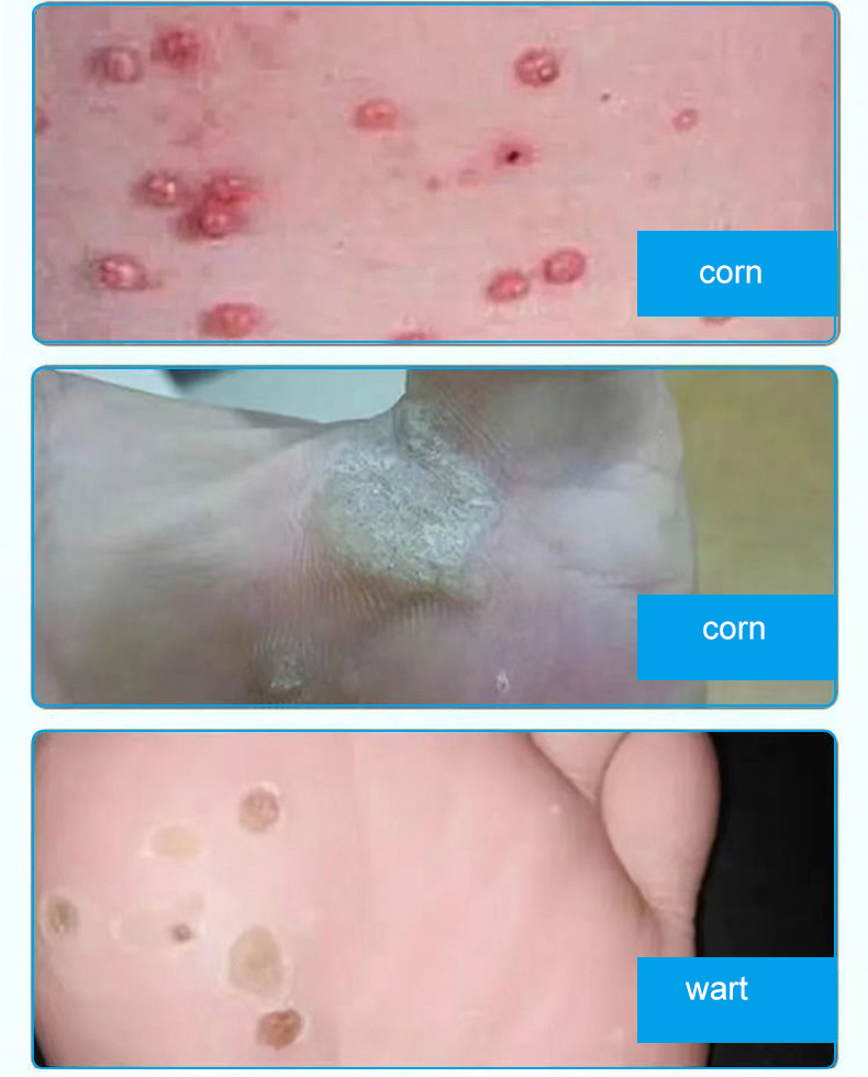 Wart Remover Common Warts Flat Warts Wart Removal Solution - Temu