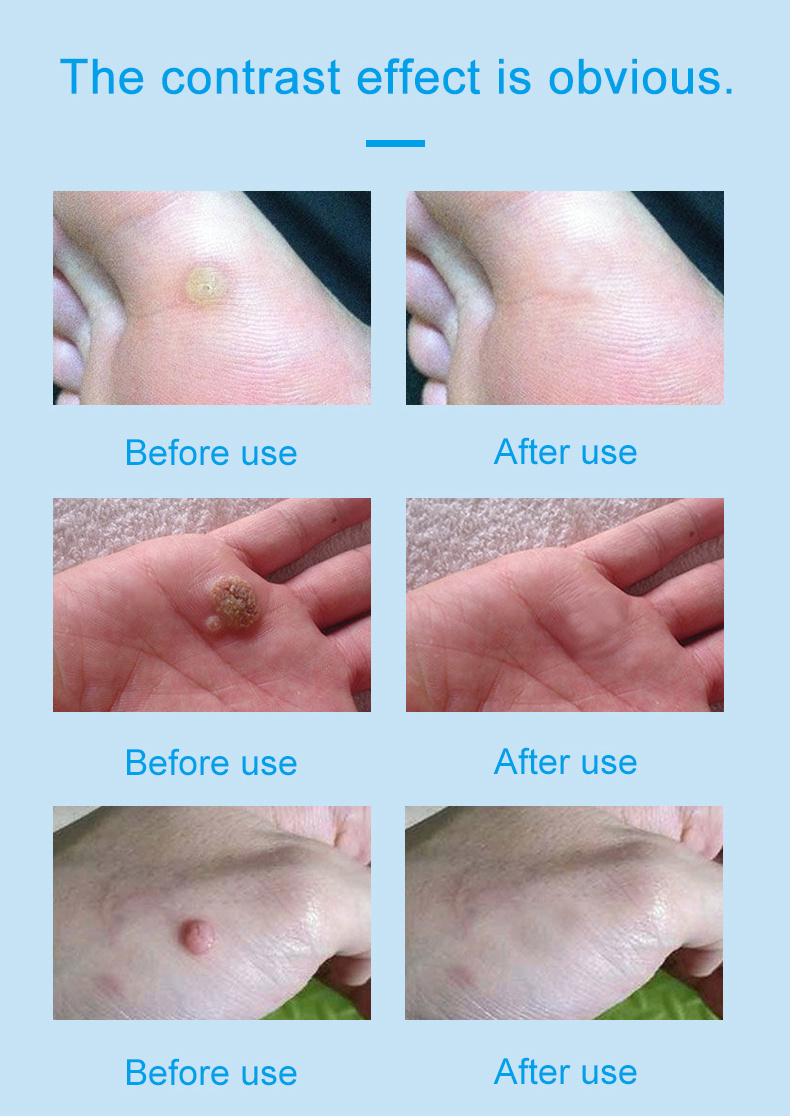 Wart Remover Common Warts Flat Warts Wart Removal Solution - Temu