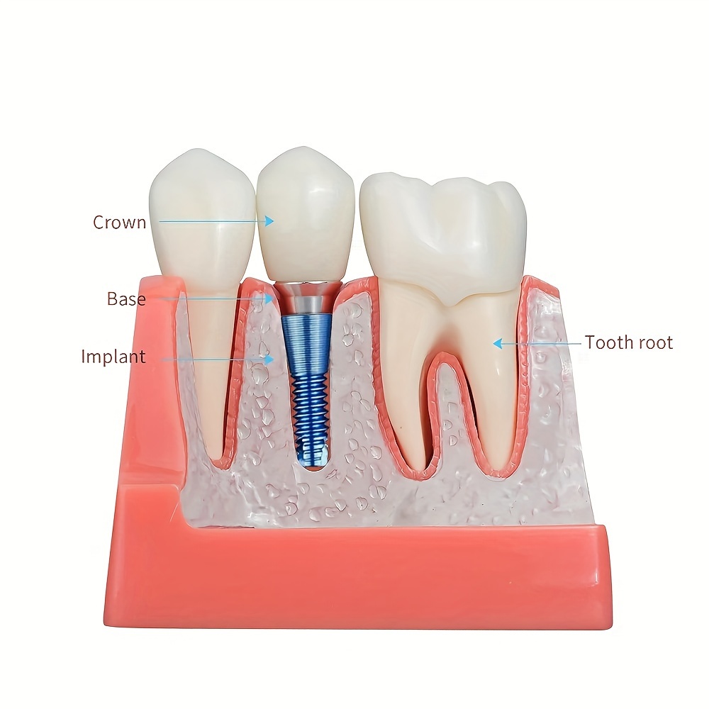BODHIS Classroom Study Implant Teeth Model Teeth Gauge Display Model ...
