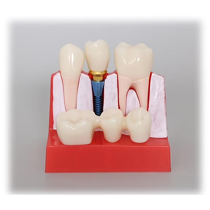 Dentures For Women IDENTical Mandibular Overdenture Model With 4 ...