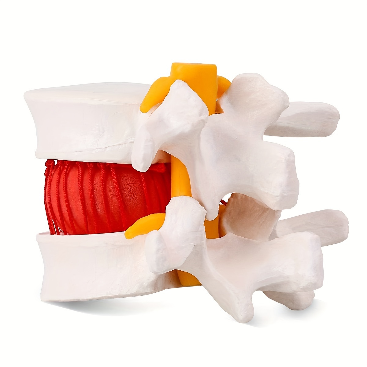 Human Anatomical Lumbar Disc Herniation Model White Lumbar Spine Model ...
